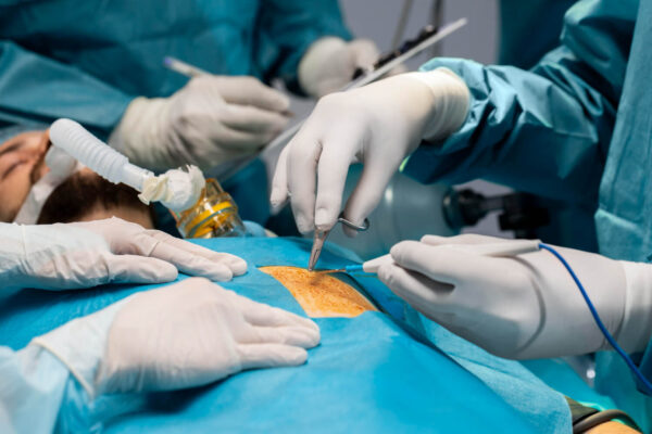 Single incision Lap surgery – MITR